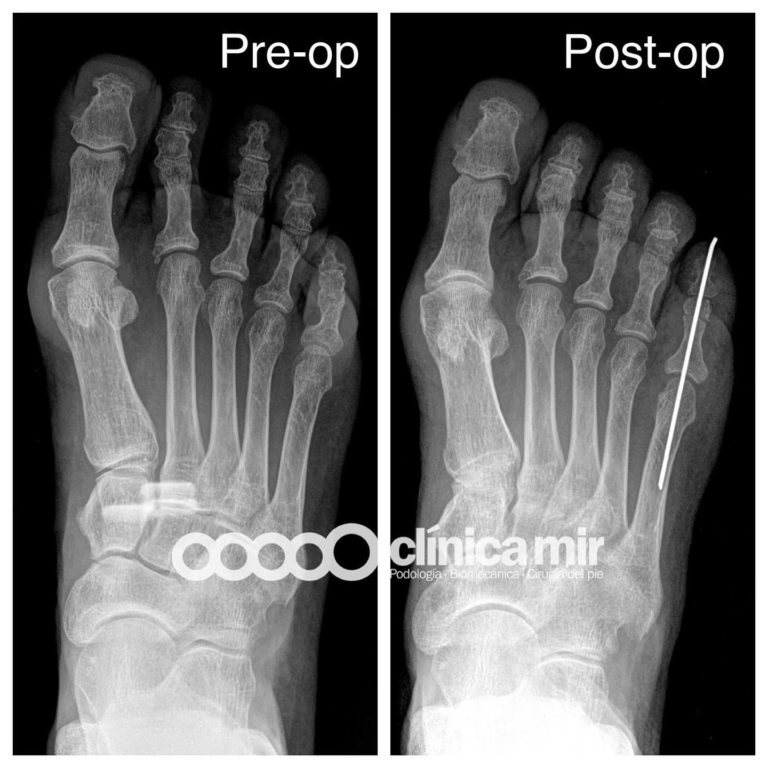Cirugía de 5º dedo supraductus y ganglón – Clinica Mir