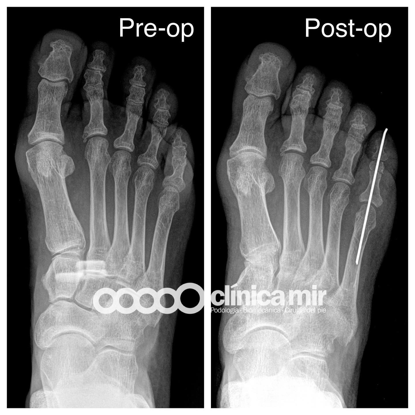 Cirugía de 5º dedo supraductus y ganglón – Clinica Mir