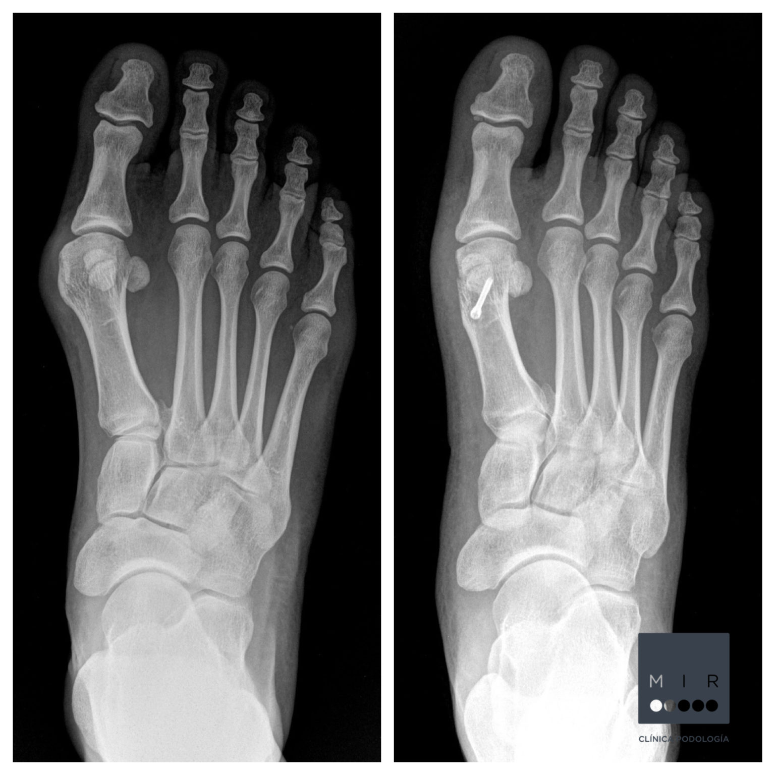Radiografía pre y postquirúrgica de una cirugía de Hallux Valgus ...