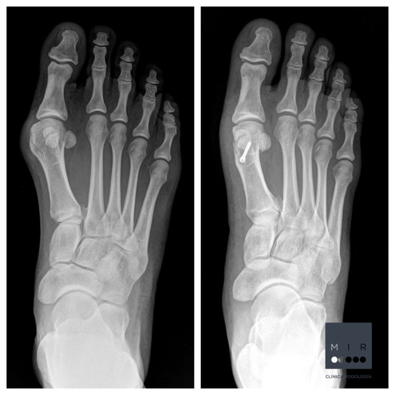 Radiografía pre y postquirúrgica de una cirugía de Hallux Valgus ...