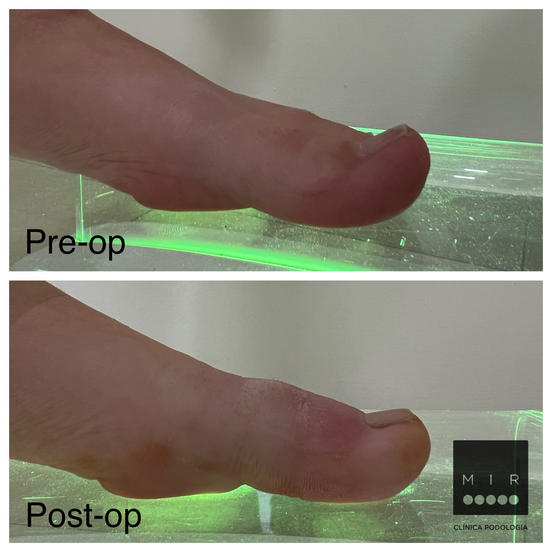 Resultado de cirugía de hallux extensus doloroso a los 14 días de la ...