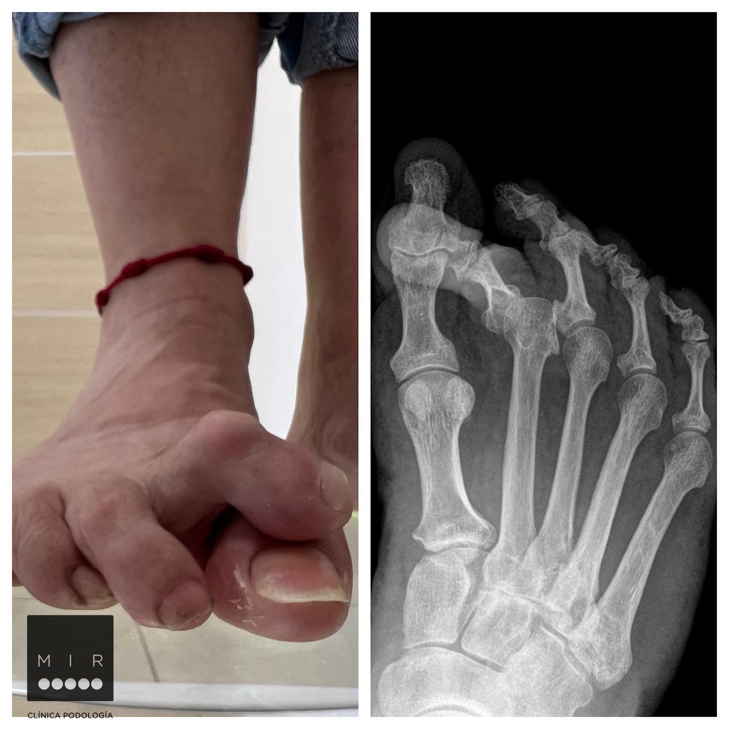 “Crossover toe” o dedo supraductus – Clinica Mir