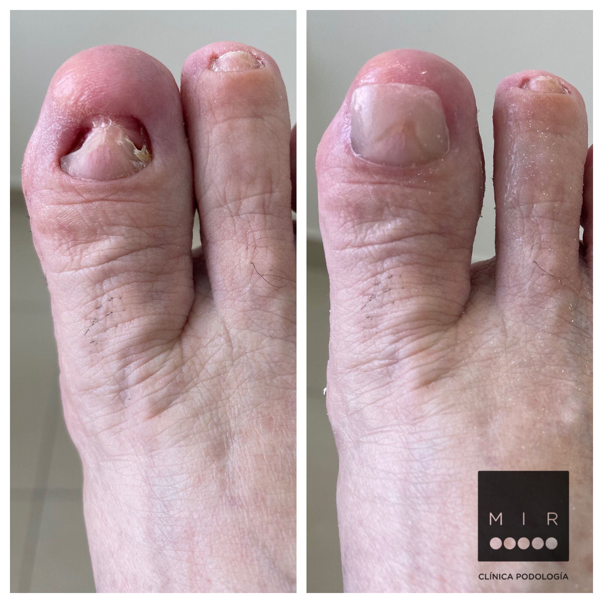 Reconstrucción ungueal por onicodistrofia – Clinica Mir